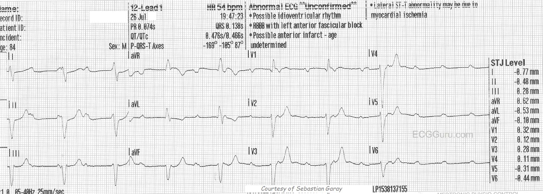 Complete AV Block ECG Guru Instructor Resources complete-av-block-ecg-guru-instructor-resources
